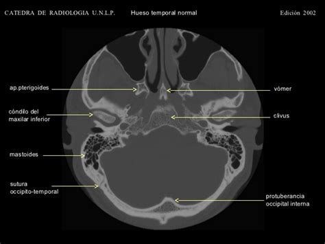 AnatomÍa Tejido óseo El CrÁneo Tc Tac Rx RadiografÍa