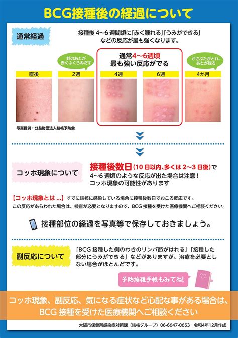 Bcgを接種された方へ