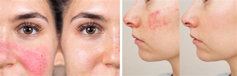 April Is Rosacea Awareness Month What You Need To Know About This