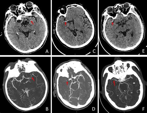 Classification Of The Hyperdense Middle Cerebral Sign Hmcas On