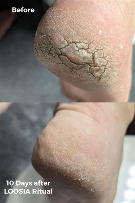 Loosia Soft Heel Reset Ritual™ Loosia™