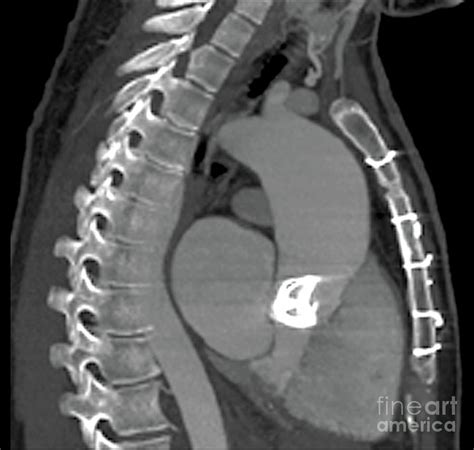 Ascending Thoracic Aortic Aneurysm Photograph By Zephyrscience Photo Library Pixels