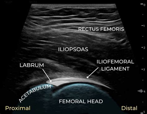 Hip Msk Ultrasound Rita Chorba Dpt