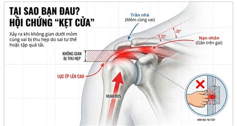 Đau Khớp Vai Và 4 Vấn đề Gây đau Vai Phổ Biến Trong Phòng Gym