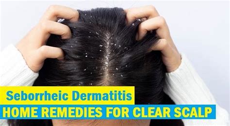 8 Effective Home Remedies For Seborrheic Dermatitis To Get Clear Scalp