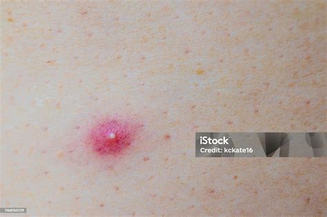 Foto Close Up Kulit Berjerawat Kistik Nodular Kulit Berjerawat Kronis