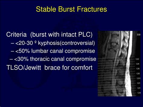 Ppt Surgical Treatment Of Fractures And Dislocations Of The Thoracic