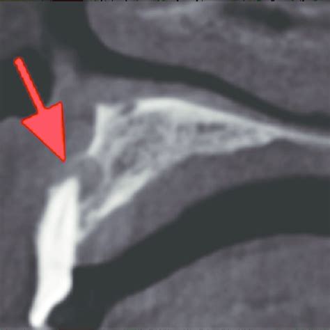 Small Radiolucency Seen With Corticated Borders Over Condyle