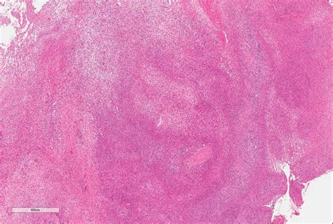 Pathology Outlines Epithelioid Sarcoma