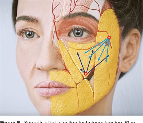 Pdf Injection Guidelines For Treating Midface Volume Deficiency With