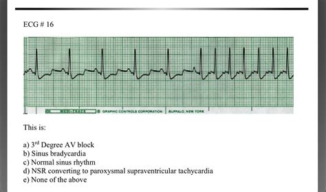 Ecg 16 This Is A 3 Rd Degree Av Block B Sinus Bradycardia C
