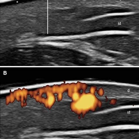 Activity Phases Of Morphea On Gray Scale Ultrasound Going From Active