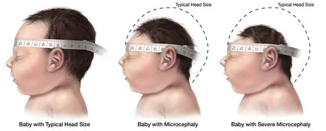 Microcephaly Measuring Public Health Notes
