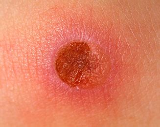Yellow Sac Spider Bite Symptoms
