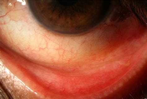 Viral Conjunctivitis Pseudomembrane Volume 4 Chapter 7 Follicular