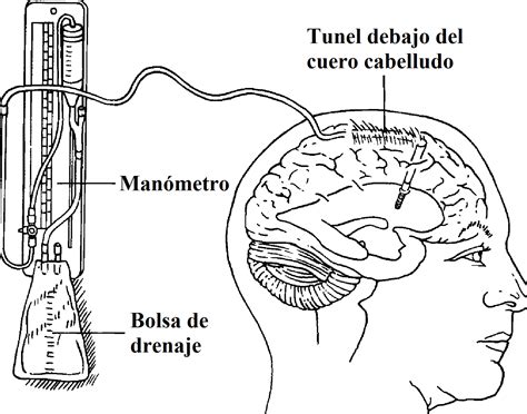 Enfermer En Urgencias Y Uci Drenaje Ventricular Externo