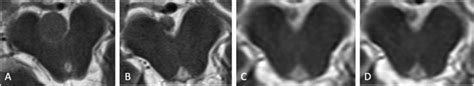 Evolution Of The Prepontine Lesion Shown On Magnetic Resonance Imaging