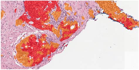 Pathologist Level Gleason Grading Using Artificial Intelligence Ai And Deep Learning Wouter Bulten