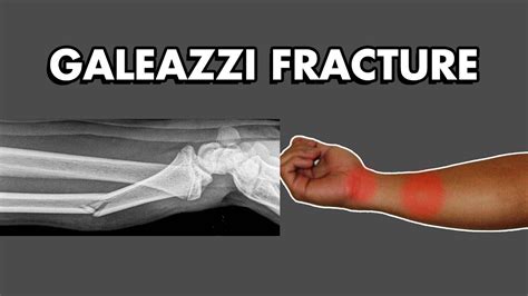 Galeazzi Fracture Complications