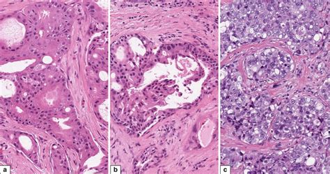 Apocrine Lesions Basicmedical Key