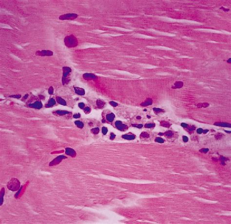 Intrafascicular Endomyosial Infiltration Of Mononuclear Inflammatory