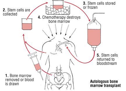Best Bone Marrow Transplant Centre In India Autologus Stem Cell