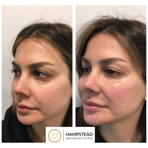 Cheek Filler Before And After Realistic Results