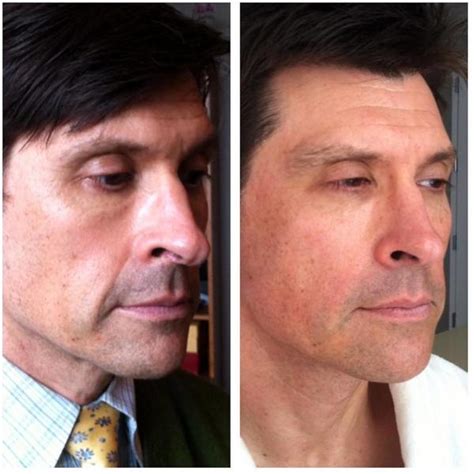 Nuface Microcurrent Before And After Photos Facelift Info Prices