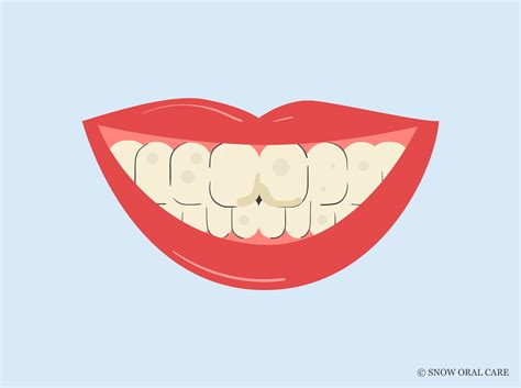 Stained Fillings Front Teeth Top Home Whitening Tricks