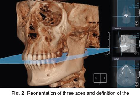 Figure 2 From An Evaluation Of Mandibular Dental And Basal Arch Dimensions In Class I And Class