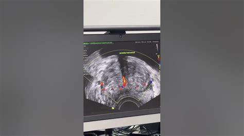Ultrasonido Doppler En Prostatitis Youtube