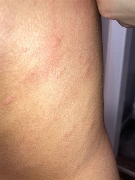 Hives Or Bug Bites Recently These Extremely Itchy Welts Started