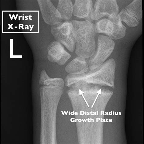 Gymnast Wrist And Why It Is So Frustrating