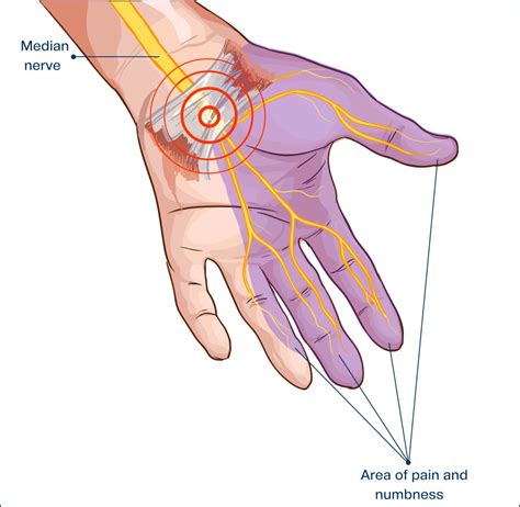 Carpal Tunnel Syndrome Non Surgical Injections And Nerve Release