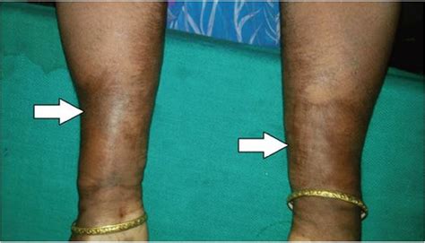 Generalized Morphea A Rare Variant Of Localized Morphea Localized