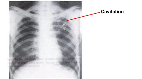 Tuberculosis Pleural Effusion Pathology Nursing Pptx