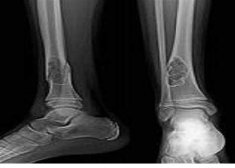 Figure 2 From Aneurysmal Bone Cyst Primary About Eight Pediatric Cases Radiological Aspects