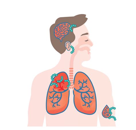 Maladies à Pneumocoques Définition Pneumoinfobe