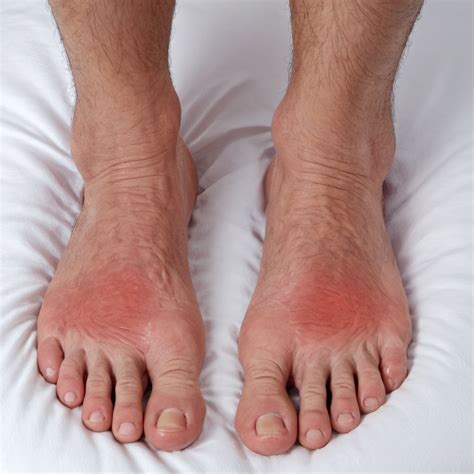 Diuretics Gout And Hydration Hydrant