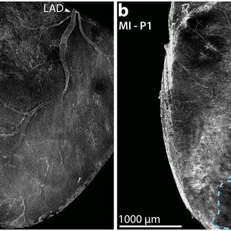 Confirmation Of Neonatal Myocardial Infarction Whole Mount Confocal