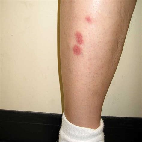 What Do Bed Bug Bites Look And Feel Like