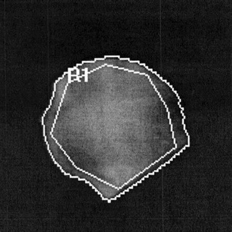 Quantitative Computed Tomography Qct In The Steps A Extraction B Download Scientific Diagram