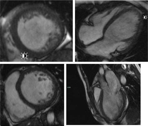 Left Ventricular Hypertrabeculationnon Compaction In A Duchennebecker