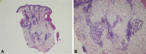 A Superficial And Deep Lymphocytic Infiltrate Perivascular And
