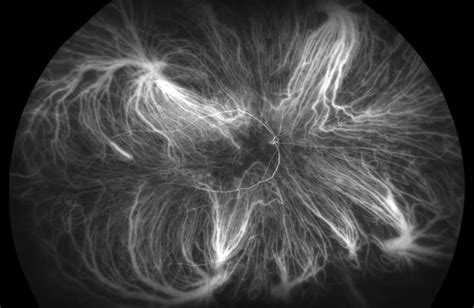 An Optomap Of Optos Insight
