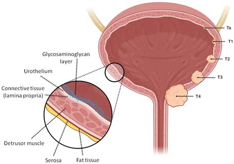 Local Drug Delivery In Bladder Cancer Advances Of Nanomicromacro Scale Drug Delivery Systems