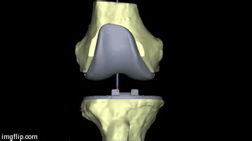 State Of The Art Knee Replacement