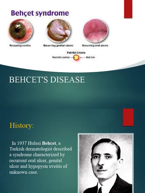 Behcets Disease Pdf Diseases And Disorders Health Sciences