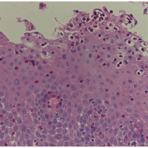 Endoscopic Appearance Of Eoe Showing A Friability Of The Mucosa And