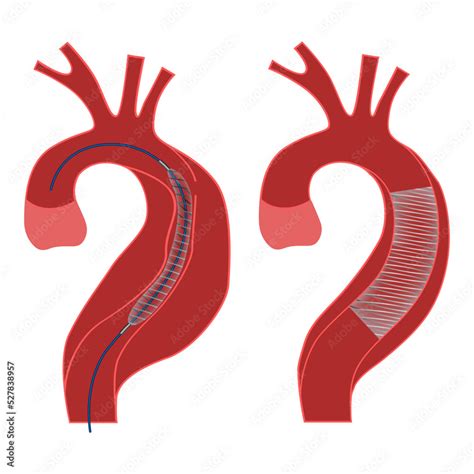 Aortic Aneurysm Aortic Stenting Diagram With Stages Medical Poster